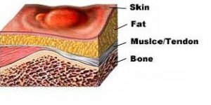 Wound Care – Quality Surgical Management