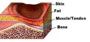 Wound Care – Quality Surgical Management